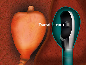 Step by step guide - HIFU-PROSTATE